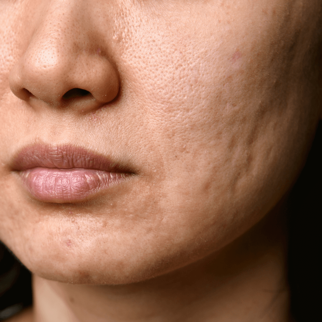 How to Get Rid of Scars - Save Face