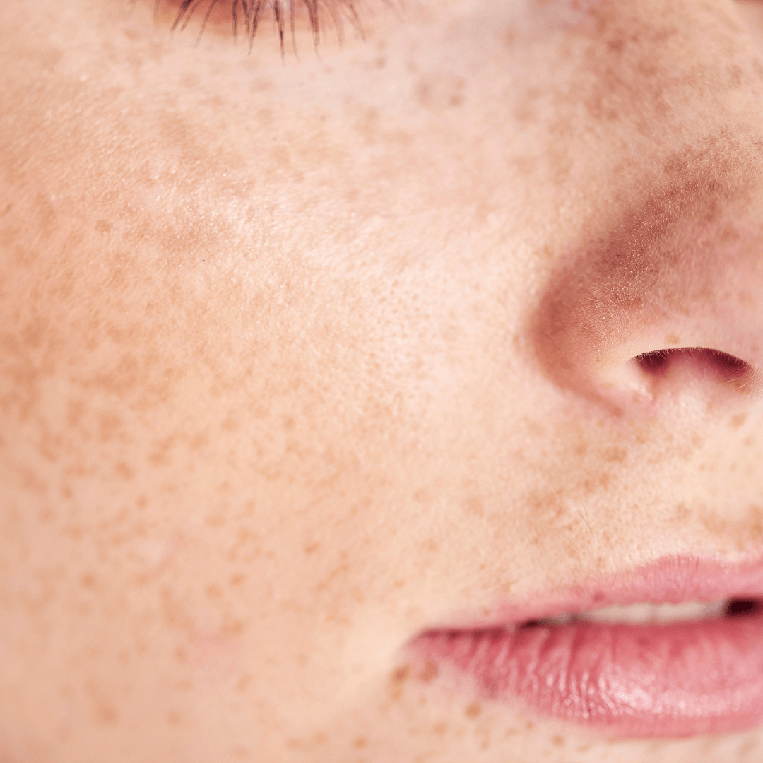 How to Get Rid of Freckles - Save Face