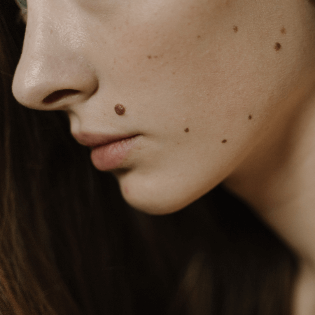 How to Get Rid of Moles - Save Face